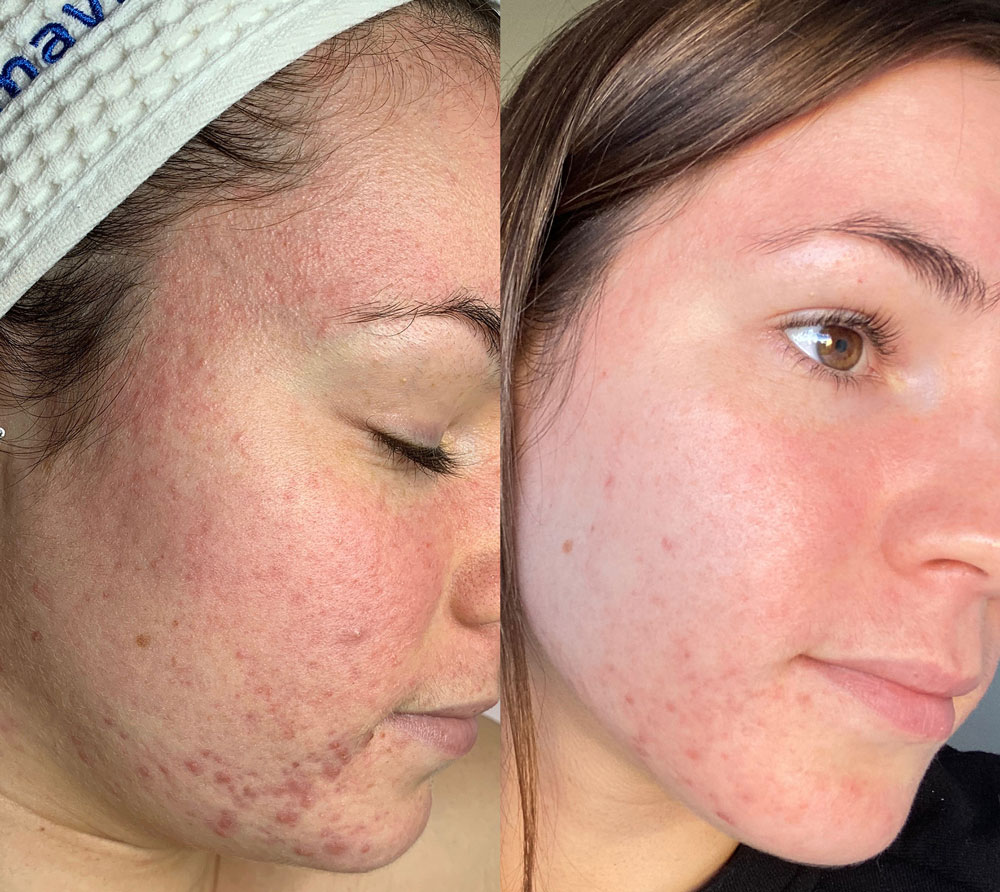 Before After - Em's Skin Boutique